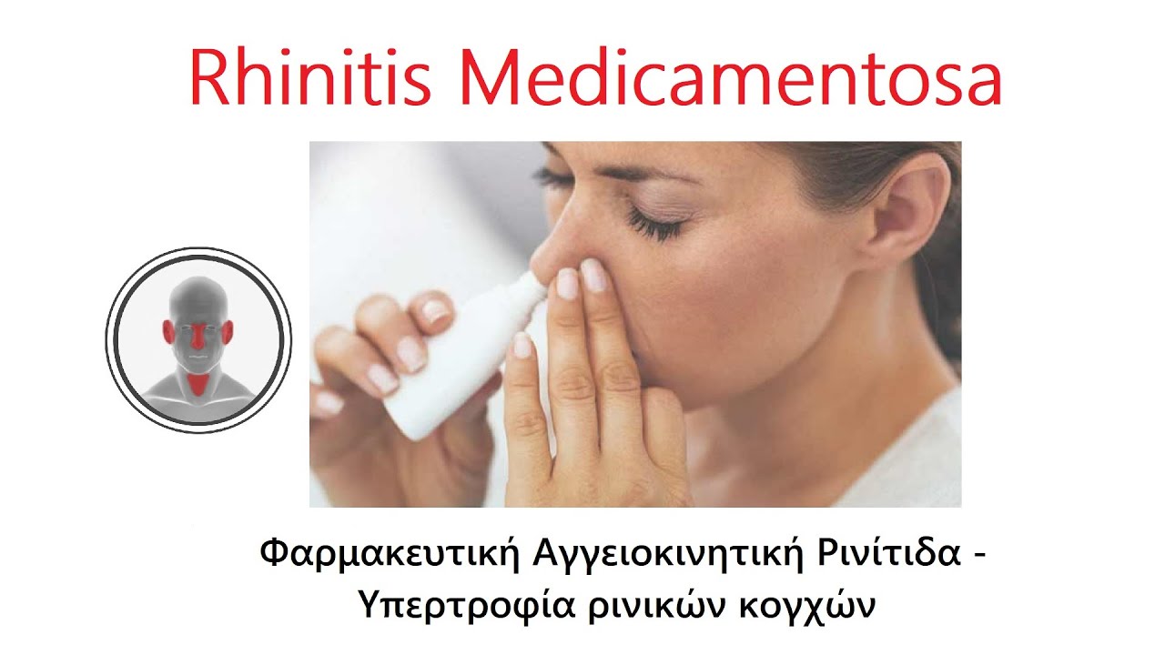 Φαρμακευτική Αγγειοκινητική Ρινίτιδα - Υπερτροφία κογχών - Πλήρης ...