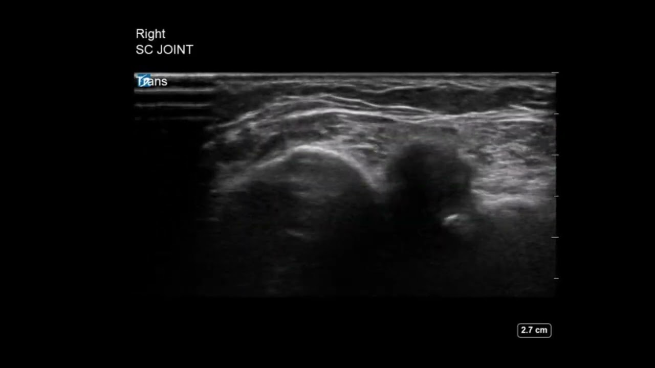 Shoulder US Sternoclavicular Joint Osteoarthritis - YouTube