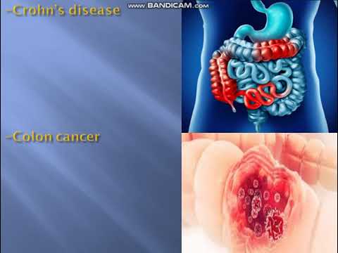 Intestinal obstruction in children - YouTube