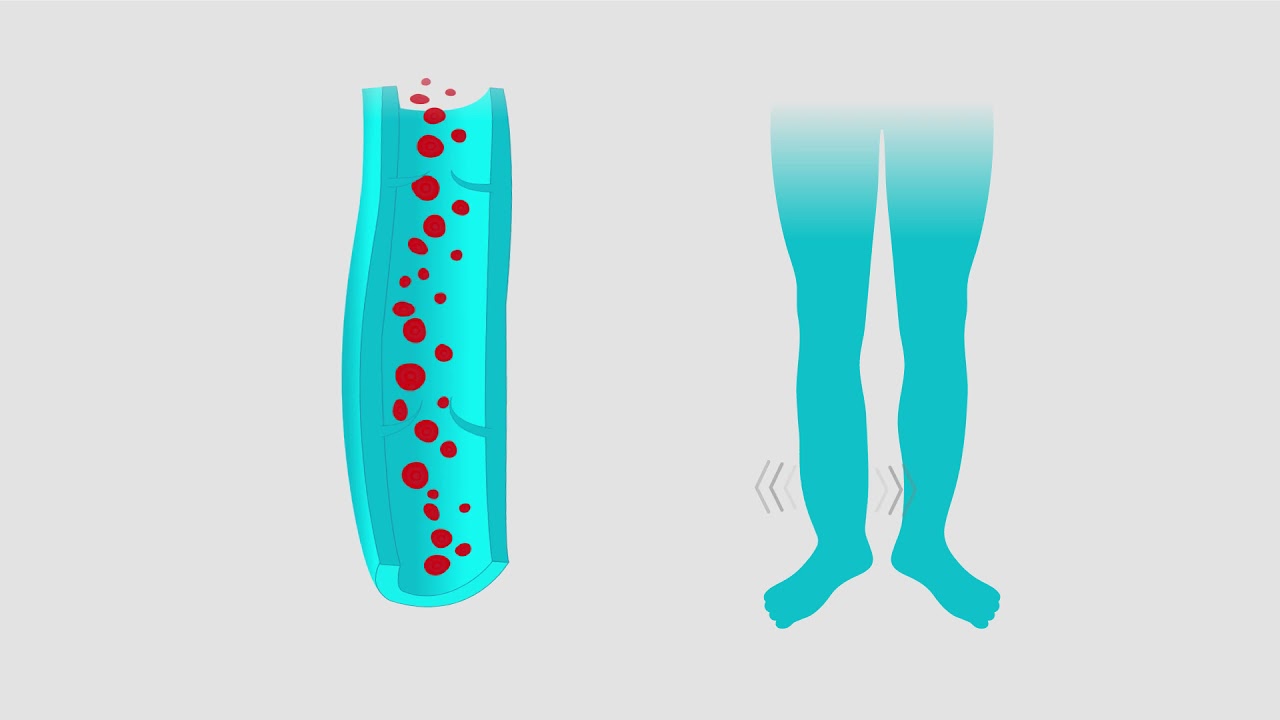 Ulcus cruris venosum - YouTube