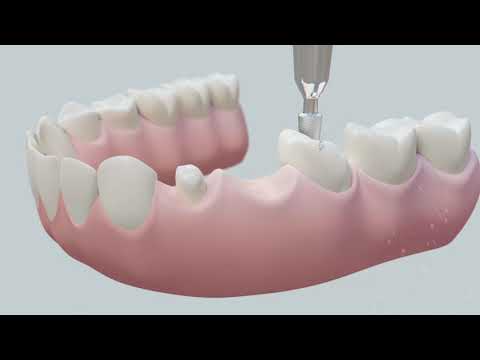 DENTAL BRIDGE PROCEDURE IN BUTTERFLY DENTAL PRACTICE - YouTube