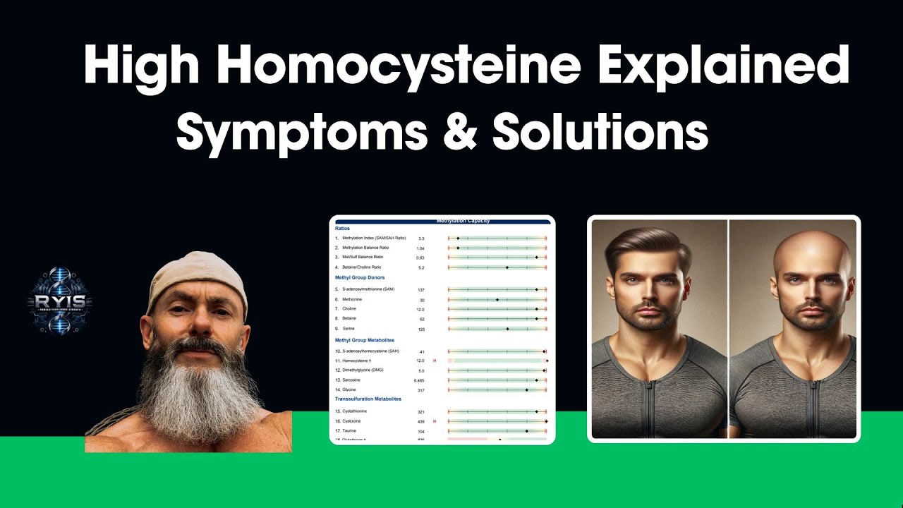 High Homocysteine Explained: Hair loss, Symptoms and Solutions - YouTube