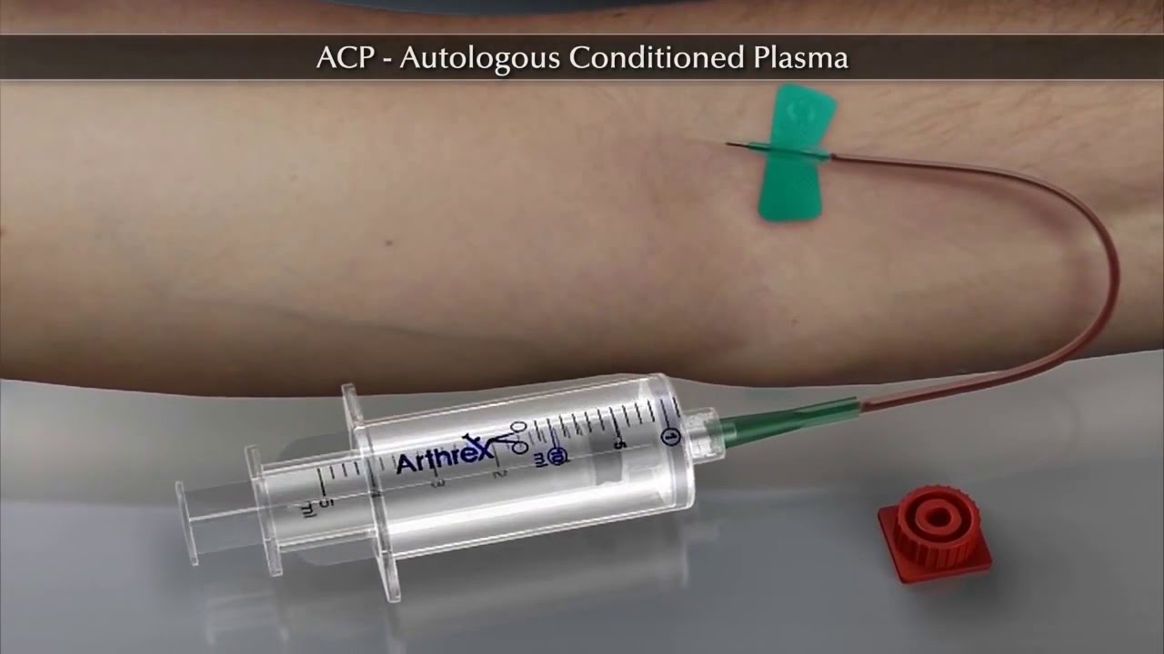 Eblal - Arthrex PRP - YouTube