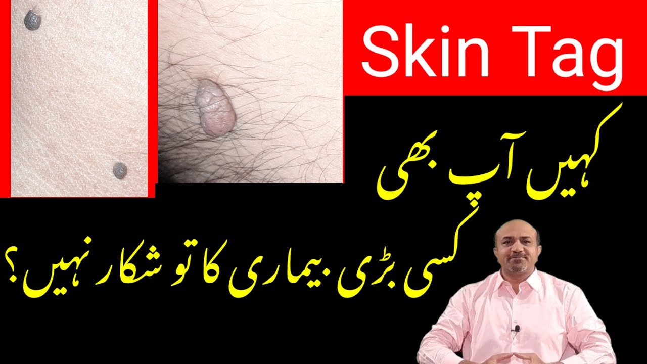 What Are Skin Tags | How Skin Tags Are Associated With Metabolic ...