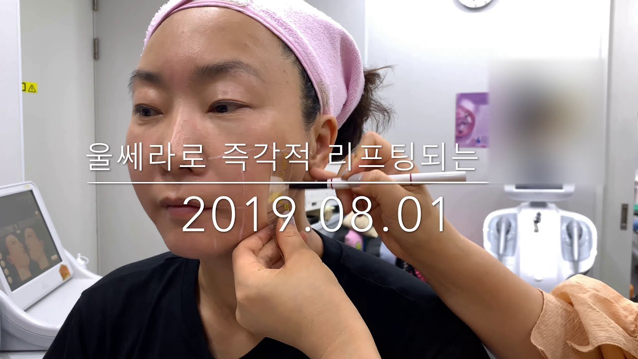 리프팅 울쎄라 울쎄라 리프팅 후 즉각적 효과가 있는지 Youtube