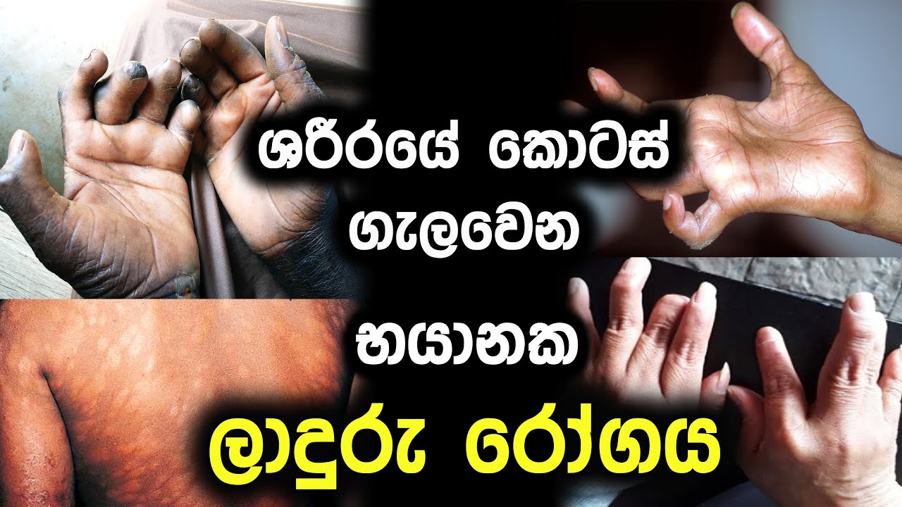 ශරීරයේ කොටස් ගැලවෙන භයානක ලාදුරු රෝගය | Ladhuru | Leprosy Sri lanka ...