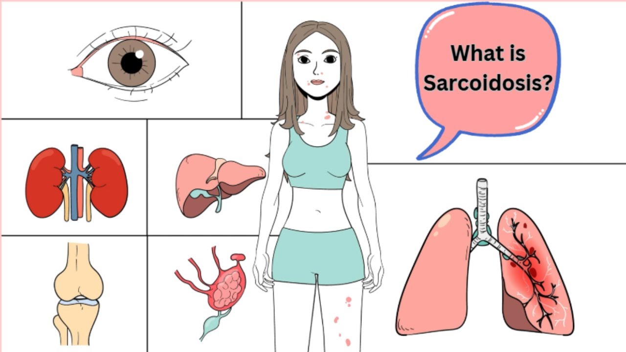 "Understanding Sarcoidosis: A Simple Mnemonic to Remember!" - YouTube