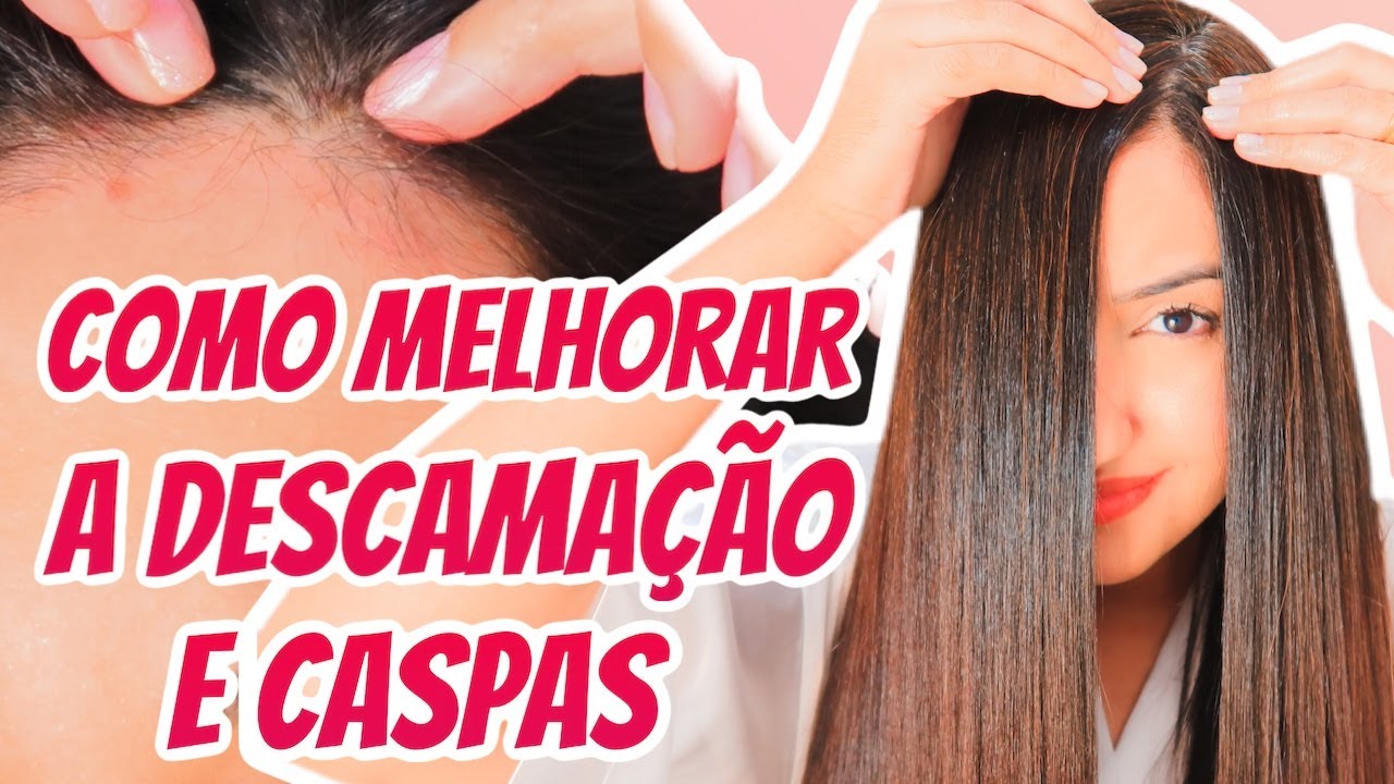 COMO MEU COURO CABELUDO COMEÇOU A PRODUZIR CASPAS E DESCAMAÇÃO ...