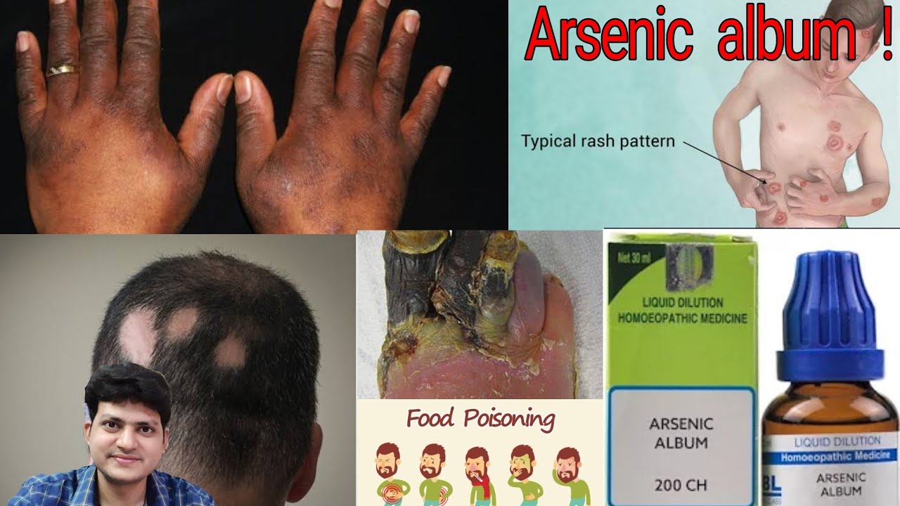 Homeopathic Medicine Arsenicum Album ! Uses ! Disease ! Symptom ! Doses ...
