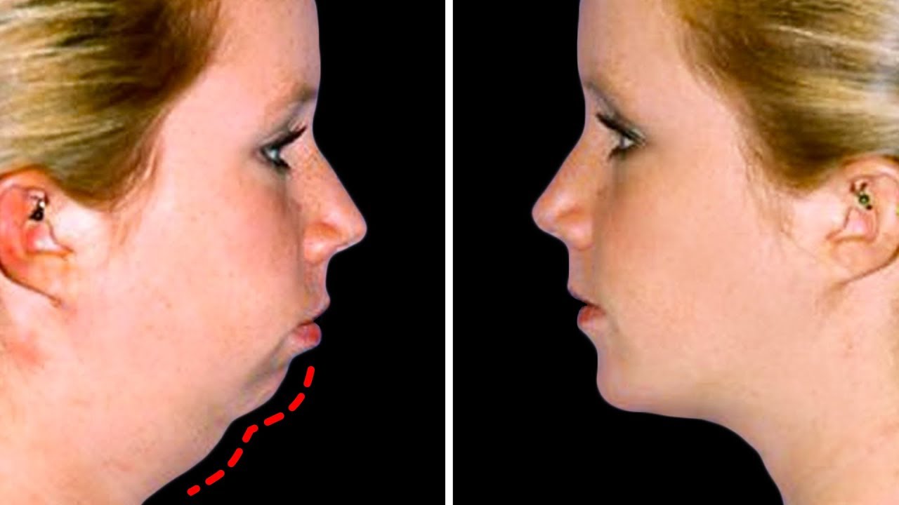 My Face Got Slimmer And The Second Chin Disappeared After I Started ...