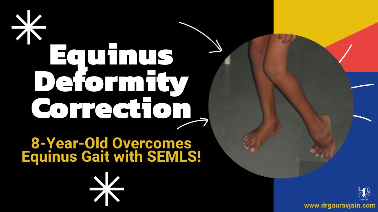 From Struggle to Strength: 8-Year-Old Overcomes Equinus Gait with SEMLS ...
