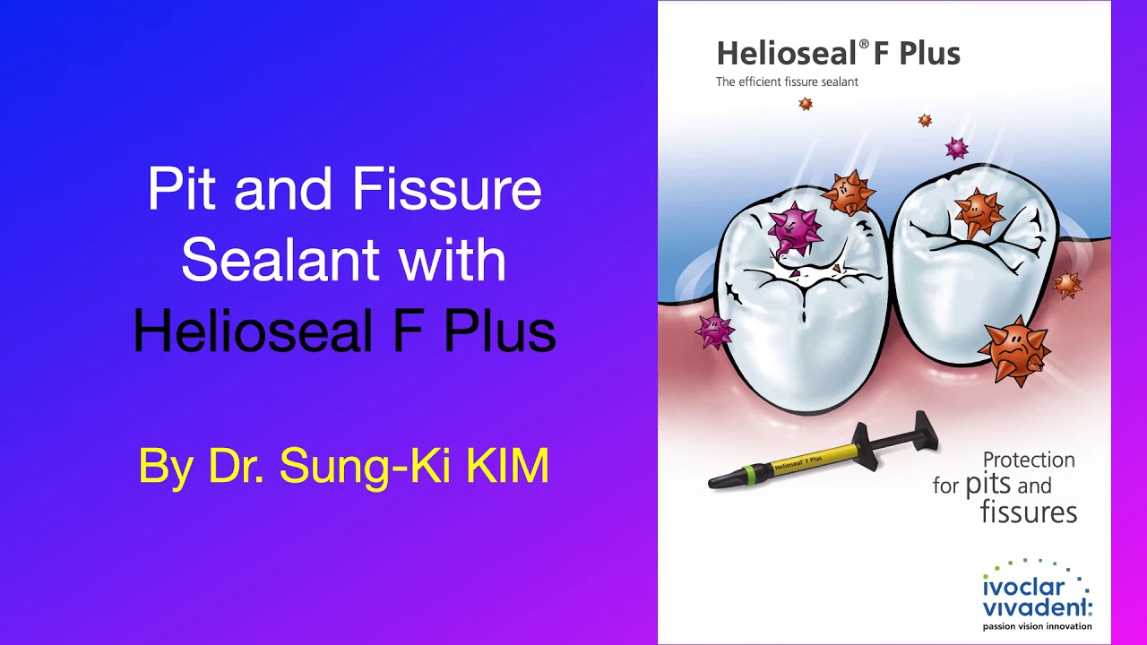 Pit and Fissure Sealant with Helioseal F Plus(Ivoclar Vivadent) by Dr ...