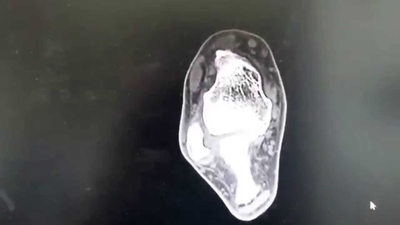 Subtalar joint coalition on CT scan, middle facet - YouTube