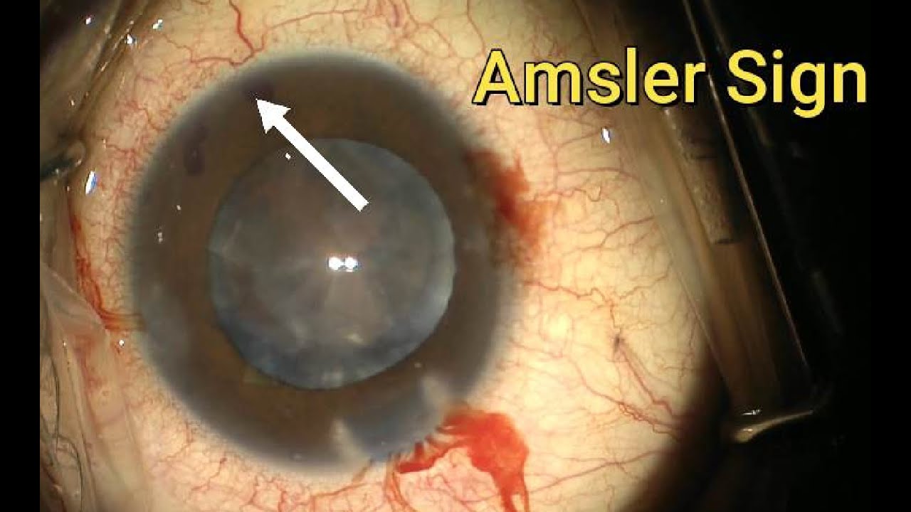 Phacoemulsification in Patient with Fuchs Heterochromic iridocyclitis ...