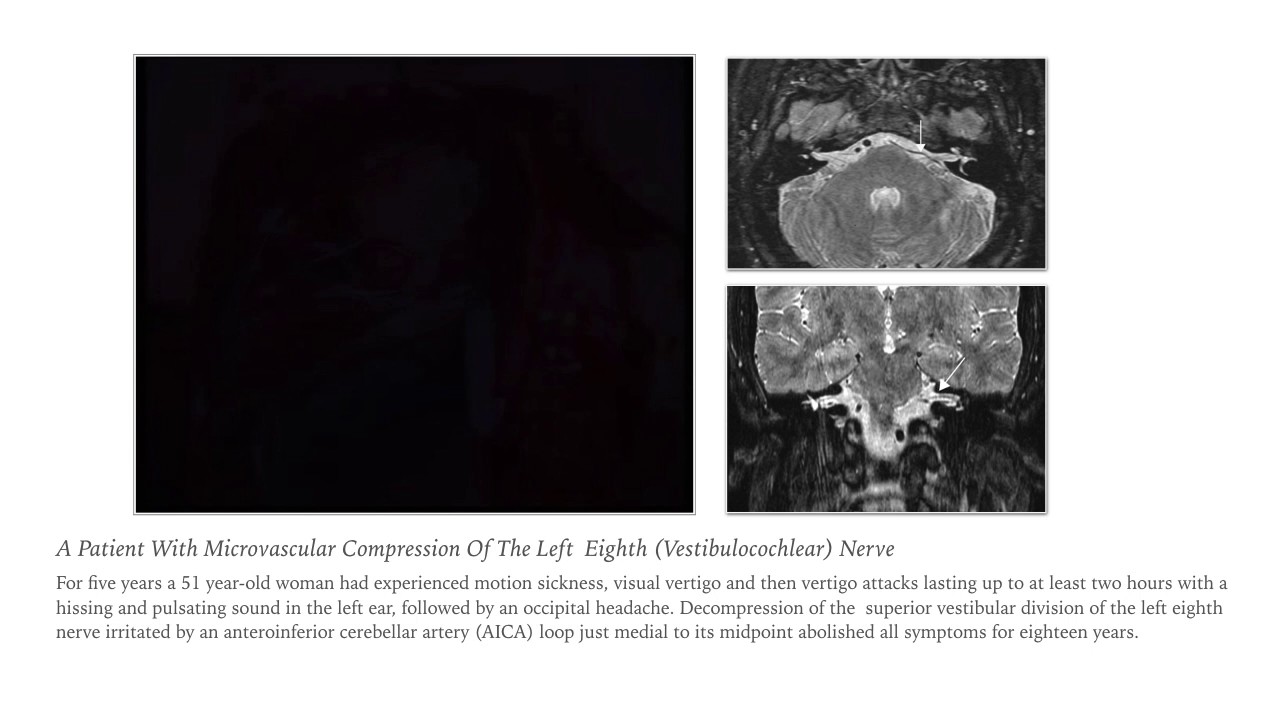 Vestibular Paroxysmia or 8th Nerve Microvascular Compression Syndrome ...
