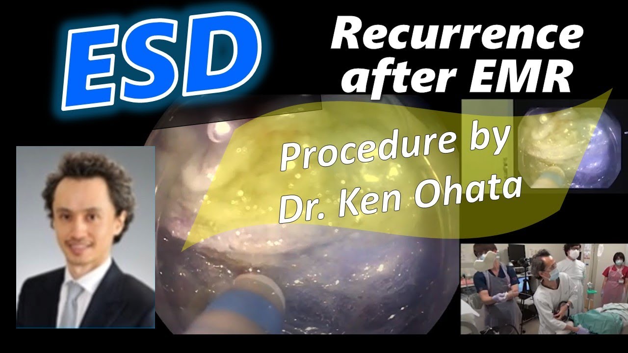 Colonic ESD for ”Recurrence after EMR” by Dr. Ken Ohata - YouTube