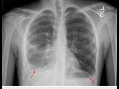 How to read Chest X-Ray? (Part 1) - YouTube