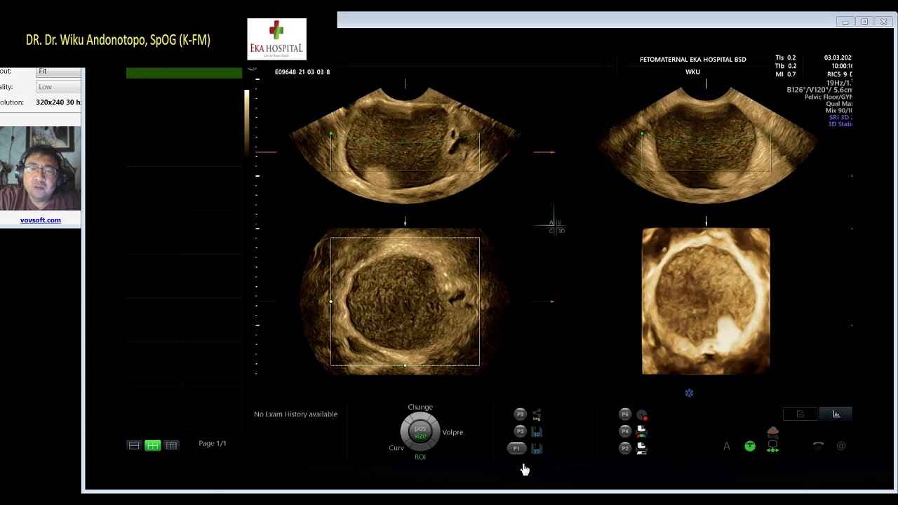 KISTA DERMOID OVARIUM (Dr Wiku Andonotopo) - YouTube