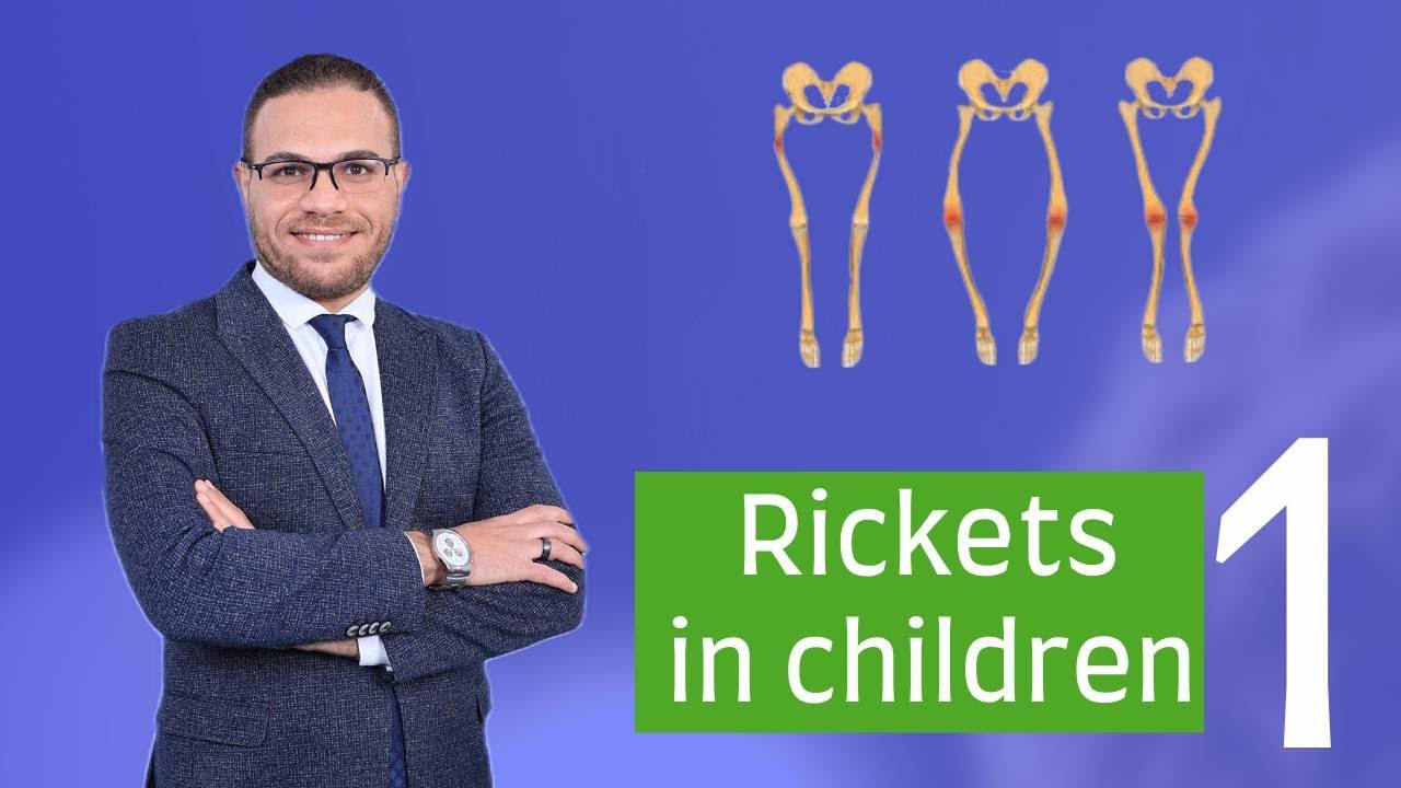 Rickets lecture part 1 | لين العظام في الاطفال - YouTube