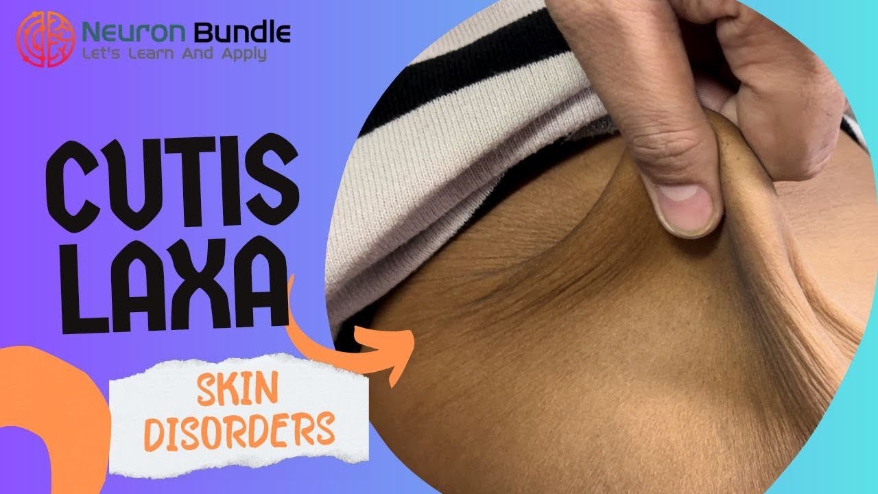 Cutis Laxa Highly Stretchable Skin Disorder Connective Tissue Cutis Laxa Highly Stretchable Skin Disorder Connective Tissue