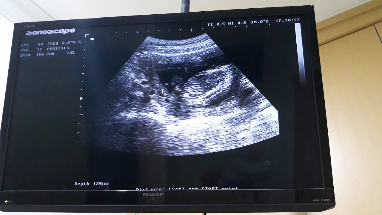 USG 2D usia 5 minggu - YouTube