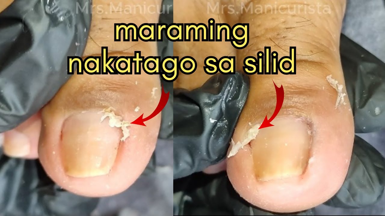 Vlog 937|Dry Skin/Ingrown Removal| PEDICURE 837 - YouTube