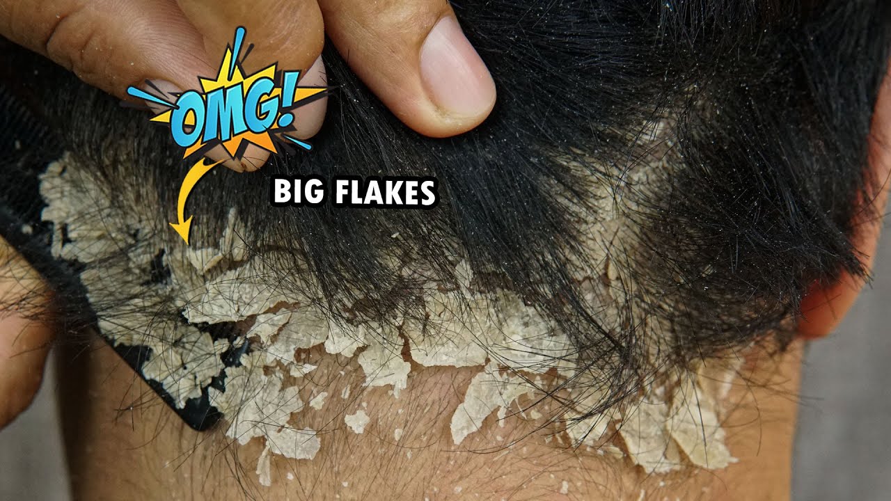 Dandruff Scratching Satisfying #1041 - YouTube