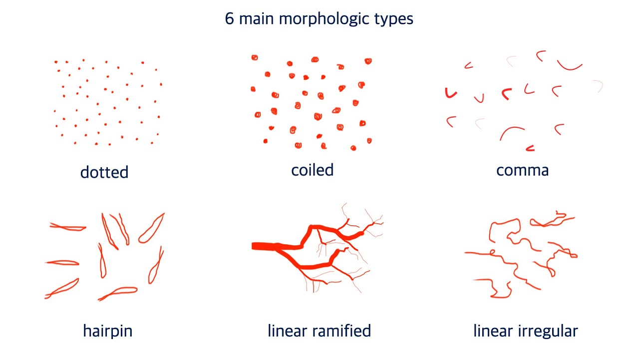 Diagnostic approach for non-pigmented tumors - YouTube