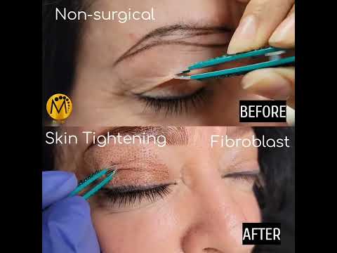 Fibroblast Skin Tightening on Eyelids Before and After - YouTube