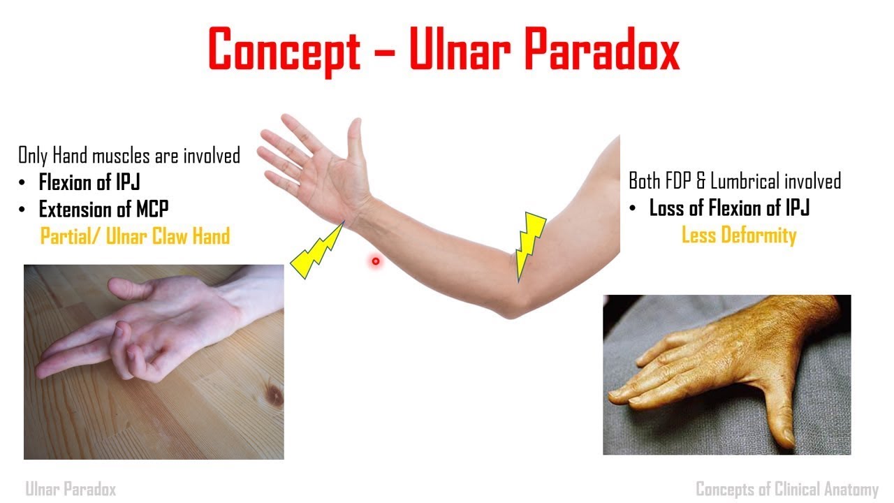 Ulnar Paradox Claw Lumbricals Of The Hand Physiopedia