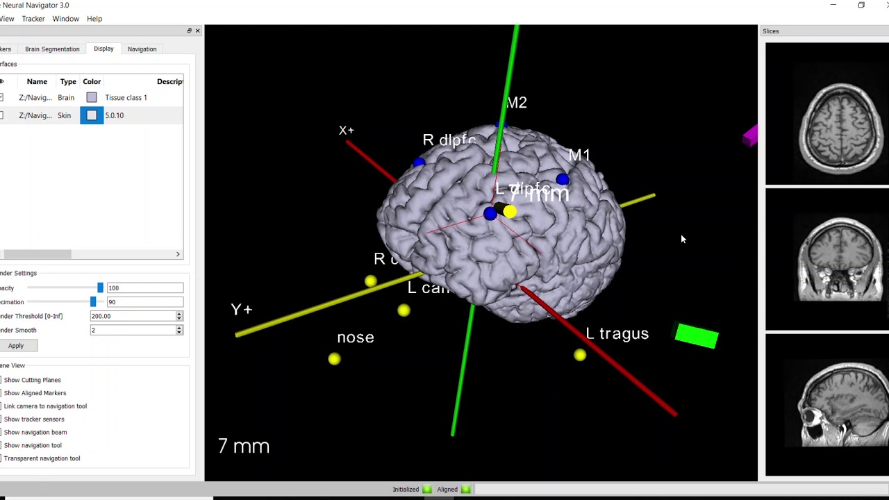 TMS with MRI navigation - YouTube