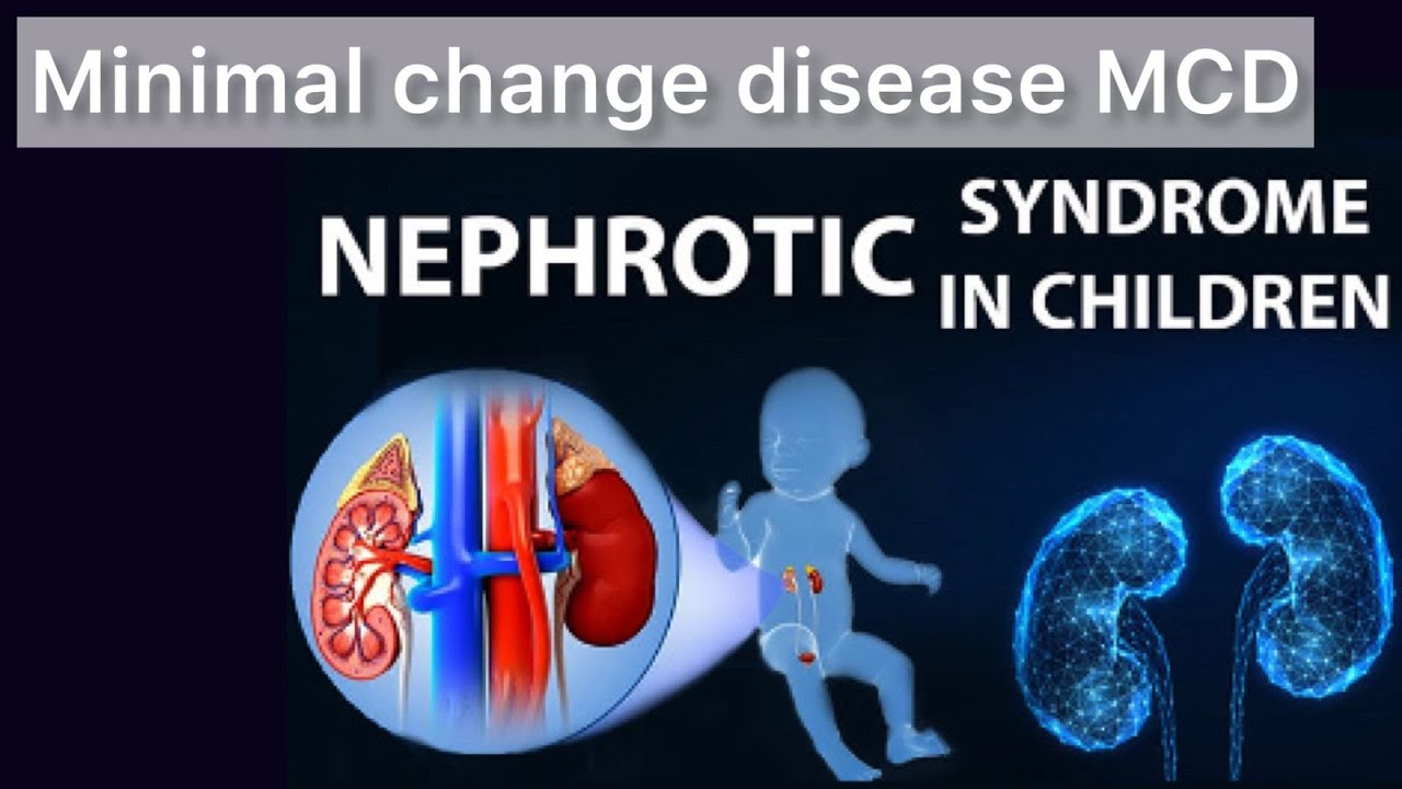 Minimal change disease MCD | CAUSES, PATHOGENESIS, MORPHOLOGY, CLINICAL ...