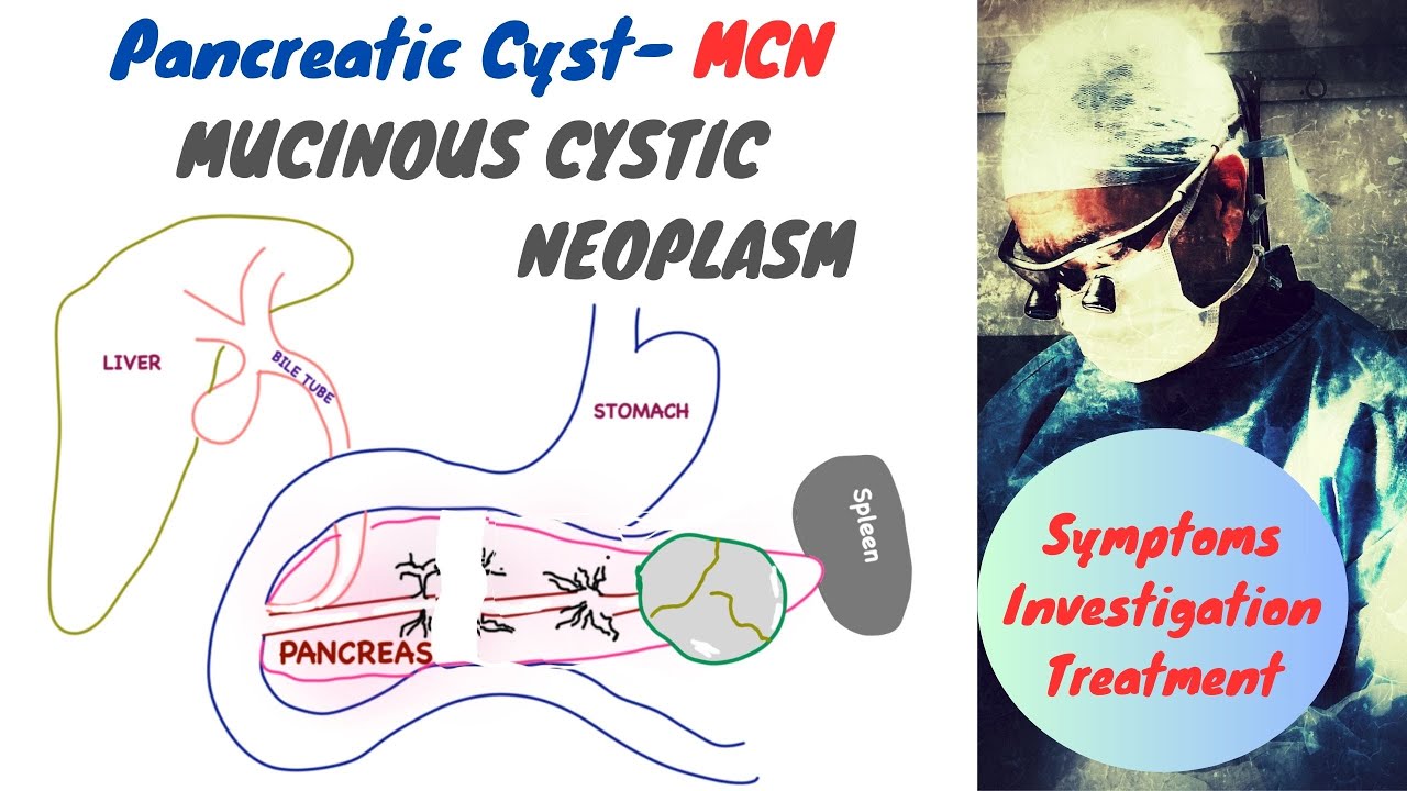 Pancreatic Cyst - Mucinous Cystic Neoplasm (MCN) - YouTube