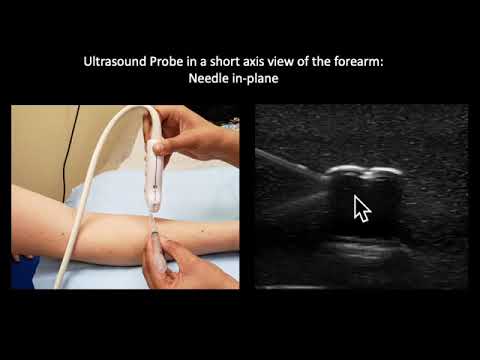 Ultrasound Probe Orientation Breast Ultrasound Probe Positioning