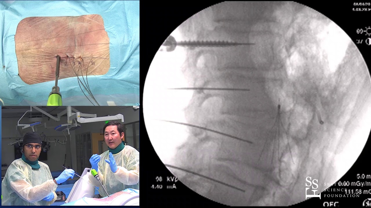 Live Demo: Percutaneous Long Segment Fixation - Jeffrey S. Roh, MD, MBA ...