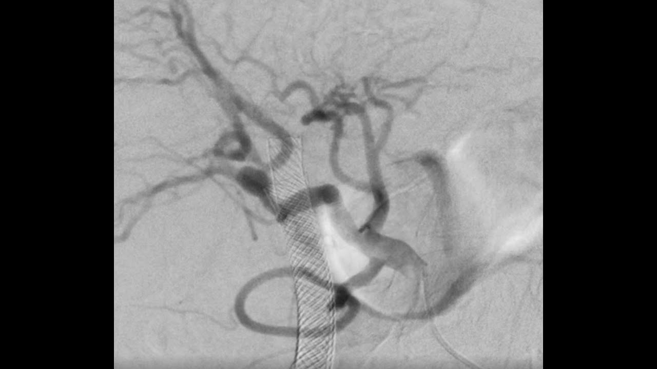 Hepatic pseudoaneurysm embolised with coils and Onyx - YouTube