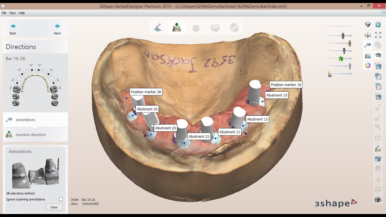 How to create an Implant Bar Order in 3Shape Dental System 2015 - YouTube
