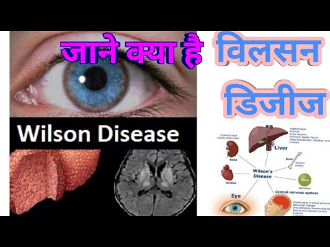 WILSON DISEASE -Cause ; Prevenction and its Treatment - YouTube