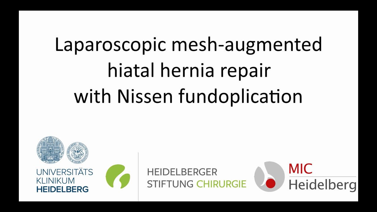 Laparoscopic mesh-augmented hiatal hernia repair with Nissen ...