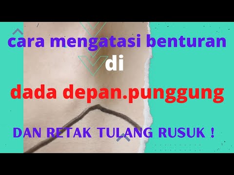cara mengatasi benturan.di dada depan.di punggung.dan retak tulang rusuk.luki afandi.