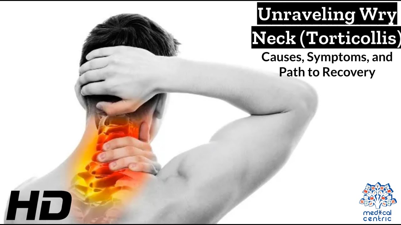 Wry Neck Torticollis: The Silent Struggle and How to Overcome It - YouTube