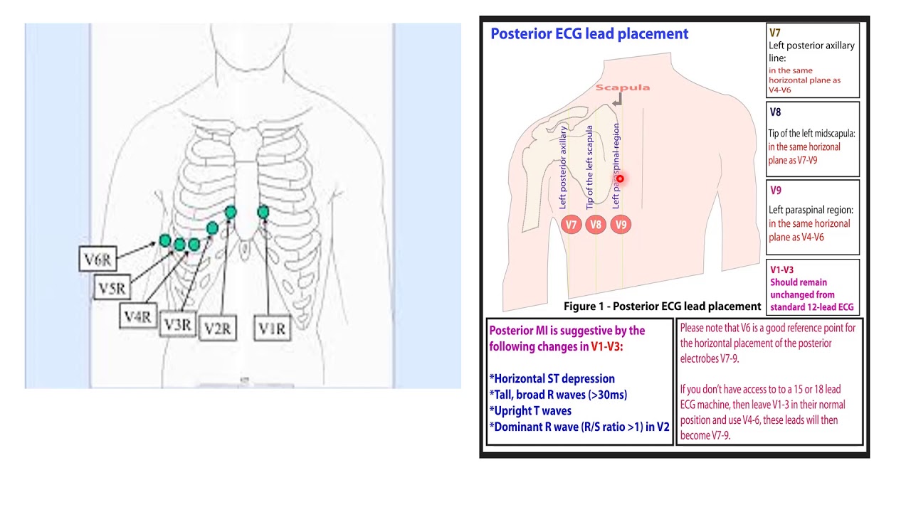ECG Basics - Part 1 - YouTube
