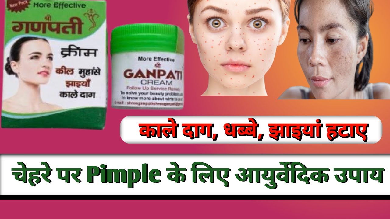 चेहरे पर Pimple के लिए आयुर्वेदिक उपाय || Ayurvedic Remedy For Pimple ...