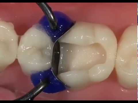 White Composite Filling a Molar - Rajan Dental