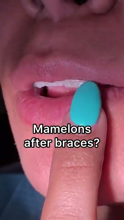 Braces off - Mamelons after braces - Tooth Time Family Dentistry New ...