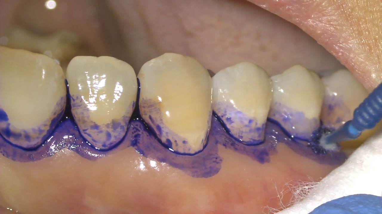 Disclosing solution application - YouTube