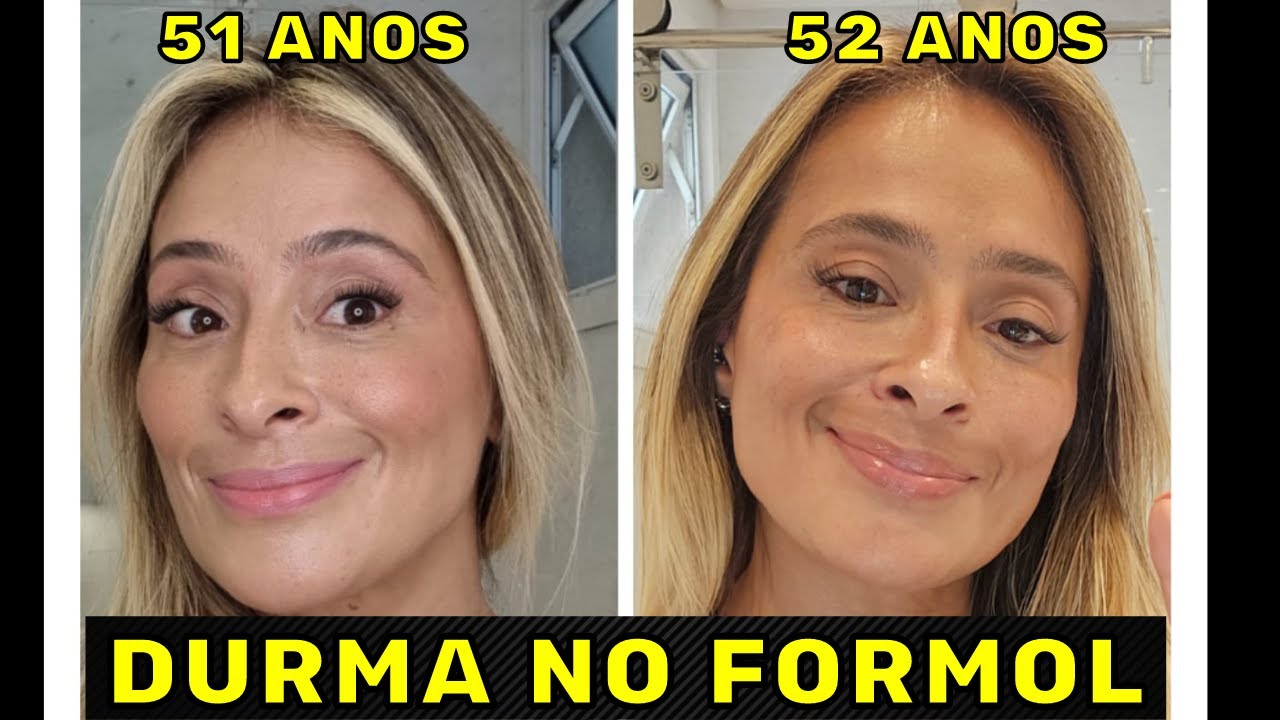 USEI Retinol, Vitacid e Vitanol o Ano Inteiro! Veja o que Aconteceu ...