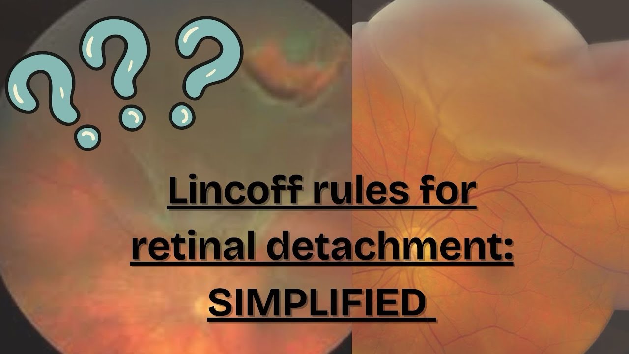 Lincoff rules for retinal detachment, Simplified ! - YouTube