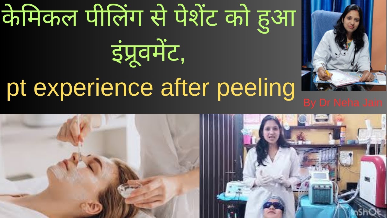 केमिकल पीलिंग से पेशेंट को हुआ इंप्रूवमेंट, pt experience after peeling ...