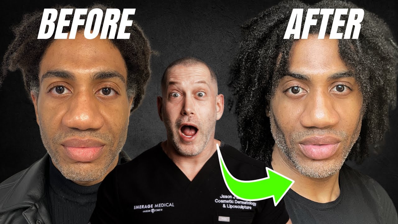 Unlocking a Sculpted Look: Male Facial Contouring BEFORE AND AFTER | Dr ...